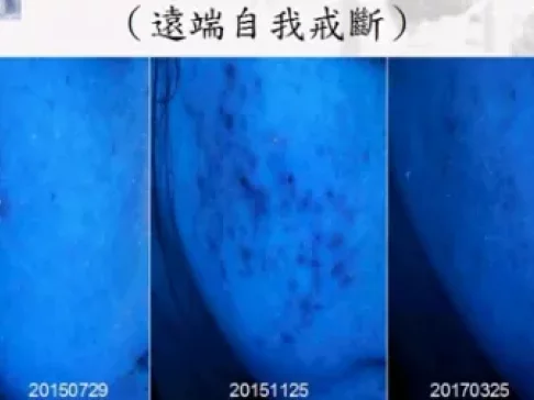 肌戒毒案例20170325=痘痘的跳後蹲.avi