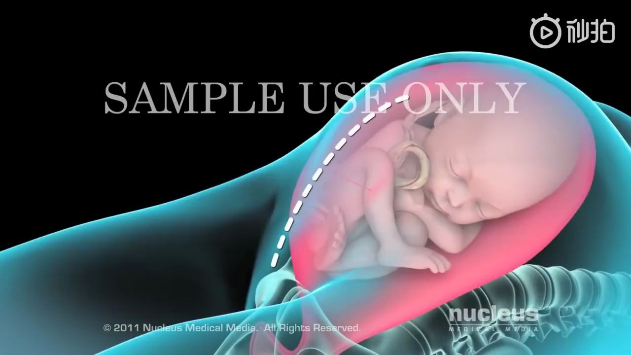 动画展示剖宫产全过程