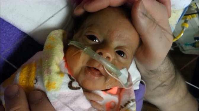 插着呼吸管的早产宝宝,弱小的模样真让人心疼