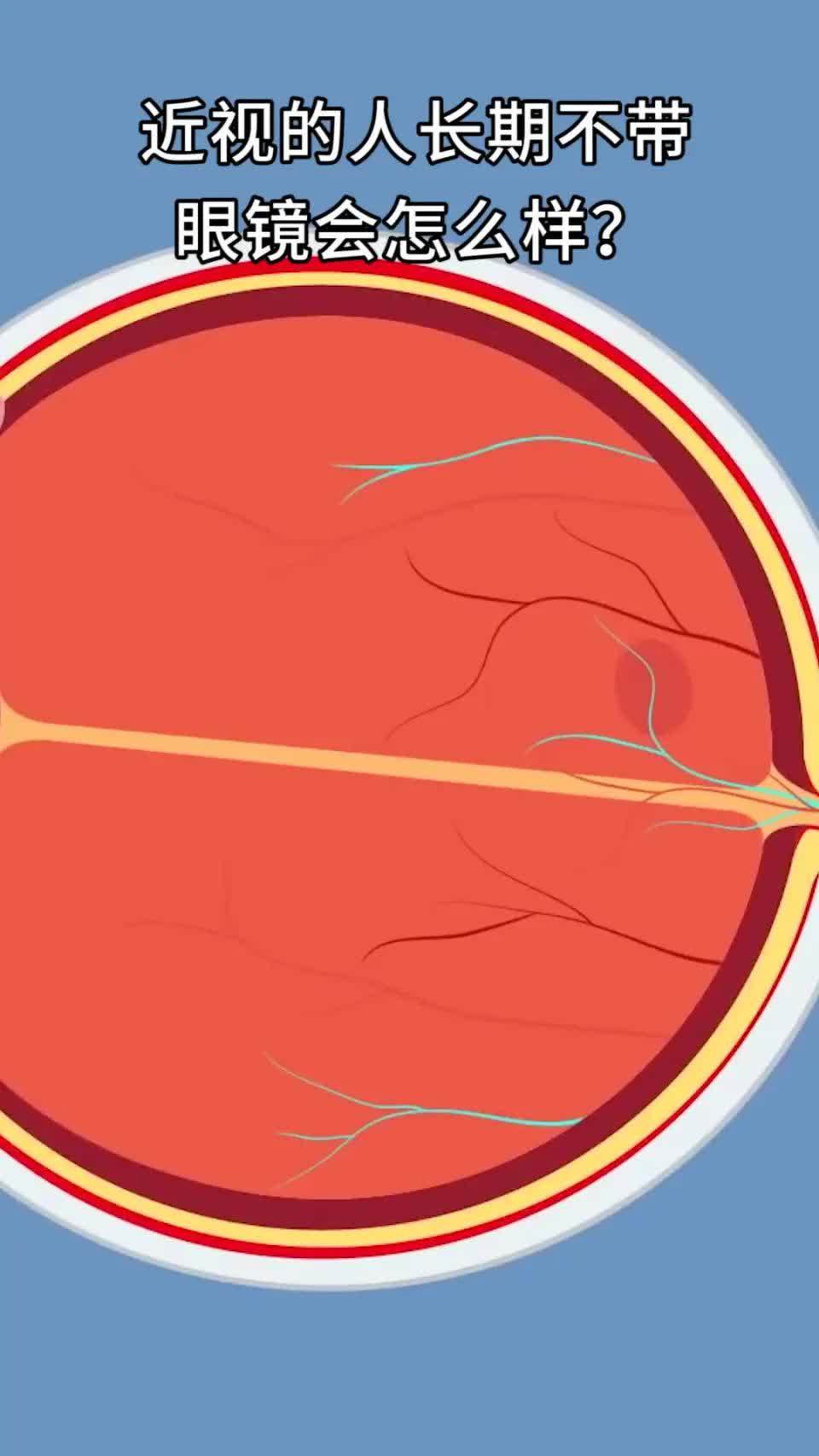 近视的人长期不带眼镜会怎么样?