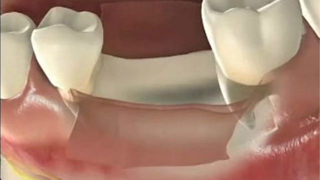 种植牙3D动画:让你看清全过程!