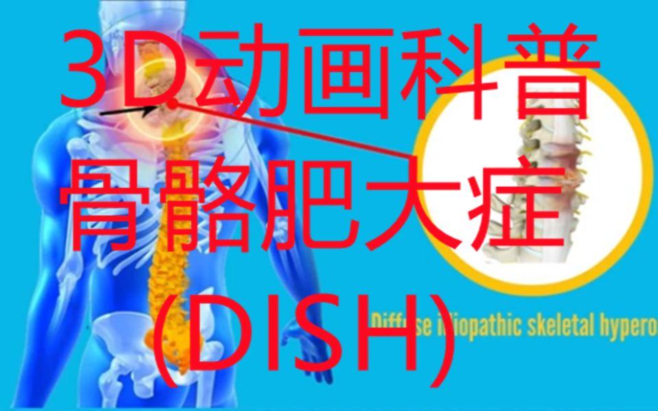 ...发性骨骼肥大症 (DISH)、原因、体征和症状、诊断和治疗-3D动画科普