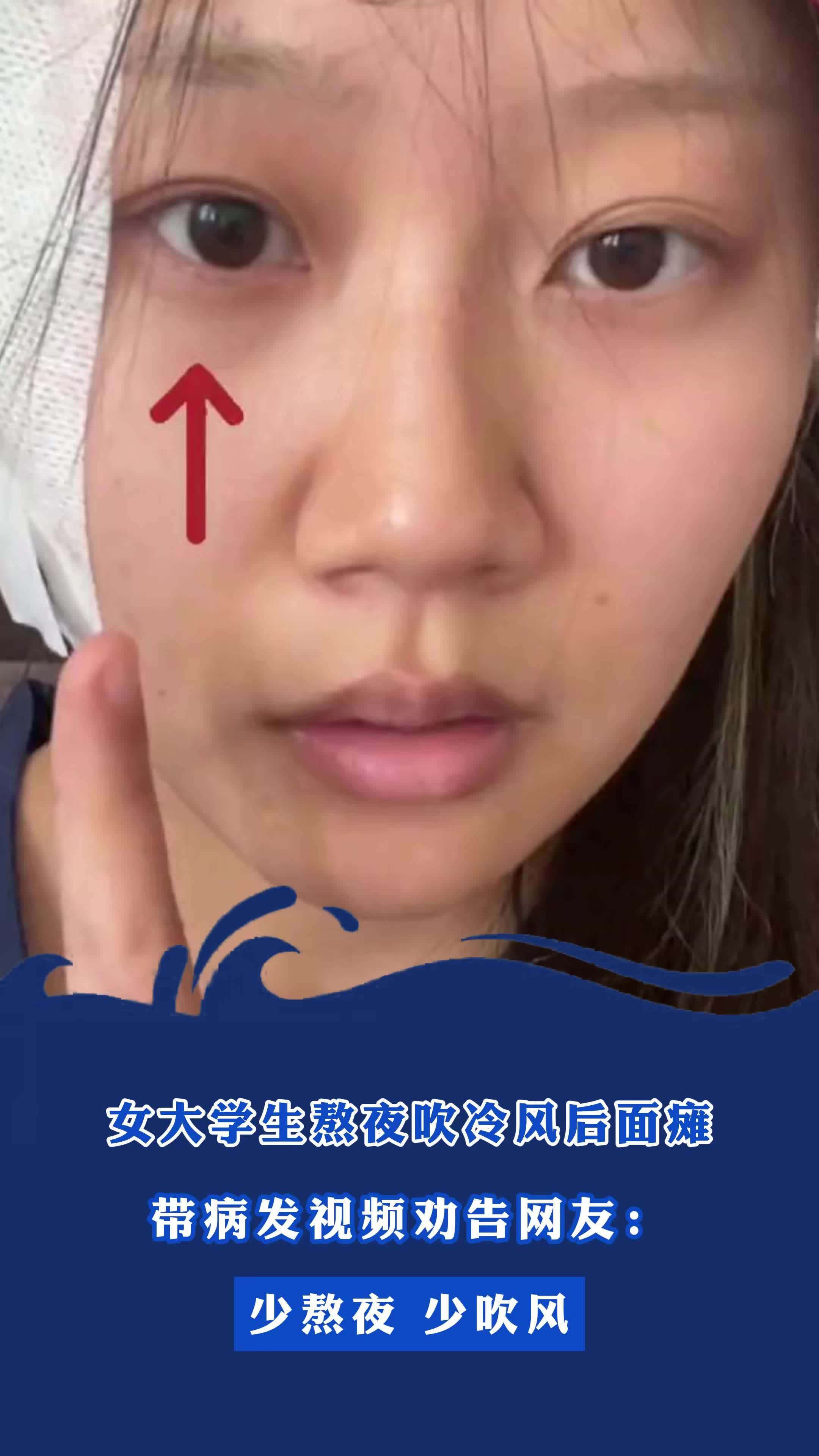 女大学生熬夜吹冷风后面瘫,带病发视频劝告网友:少熬夜,少吹风