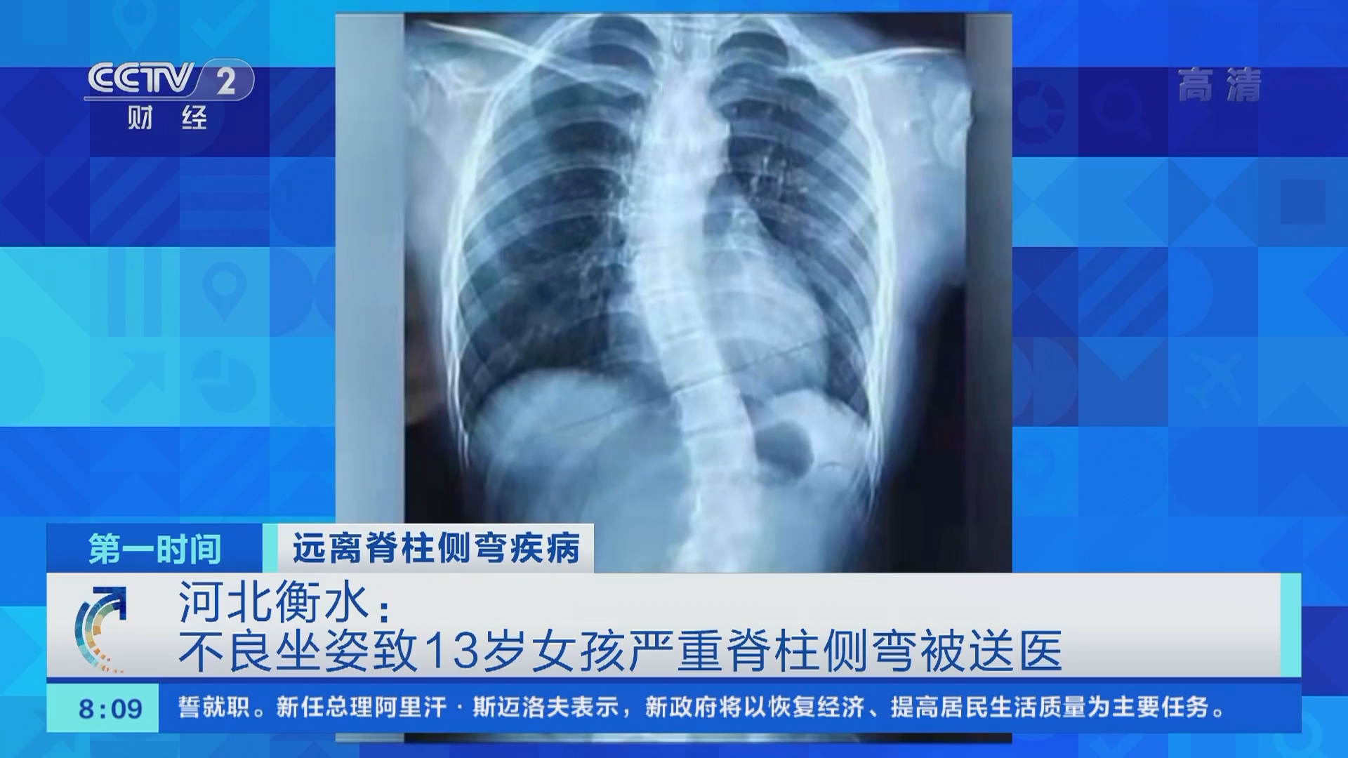 [第一时间]远离脊柱侧弯疾病 河北衡水:不良坐姿致13岁女孩严重脊柱...