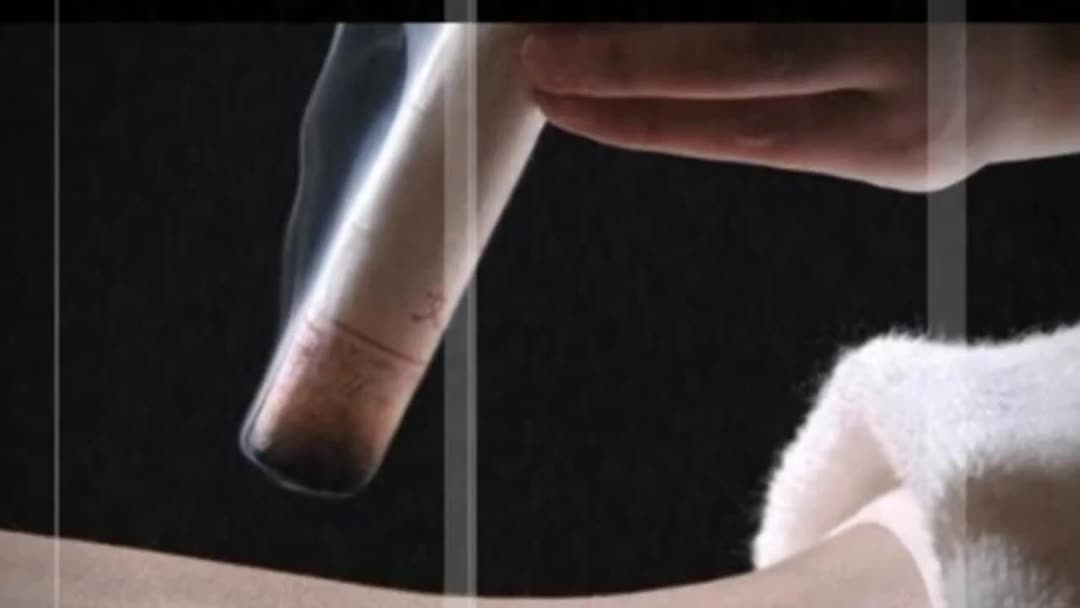 大妈艾灸治痔疮致大出血 神秘疗法让人哭笑不得