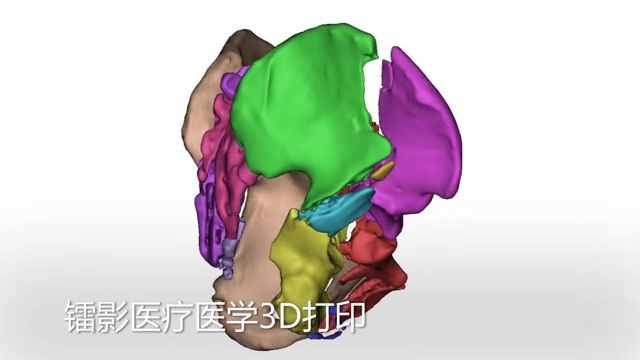 这该是多大的事故啊,四十多的壮汉伤成这个样子#医学3d打印