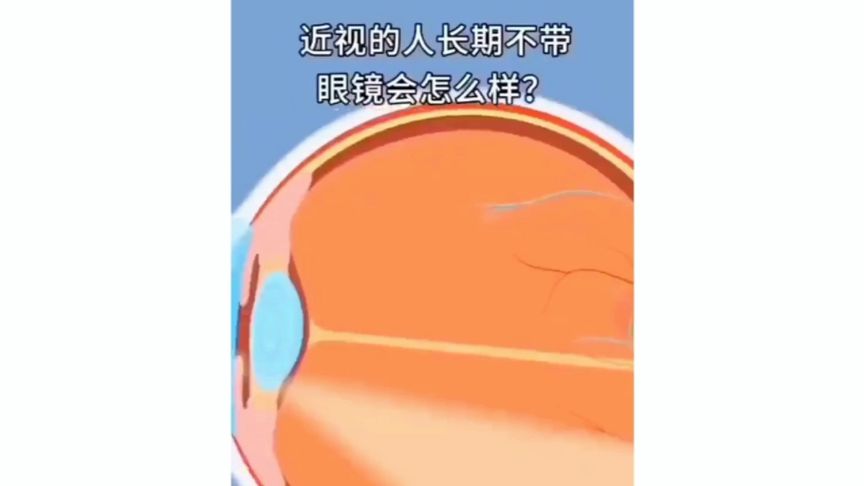 近视的人常年不带眼镜会怎么样?