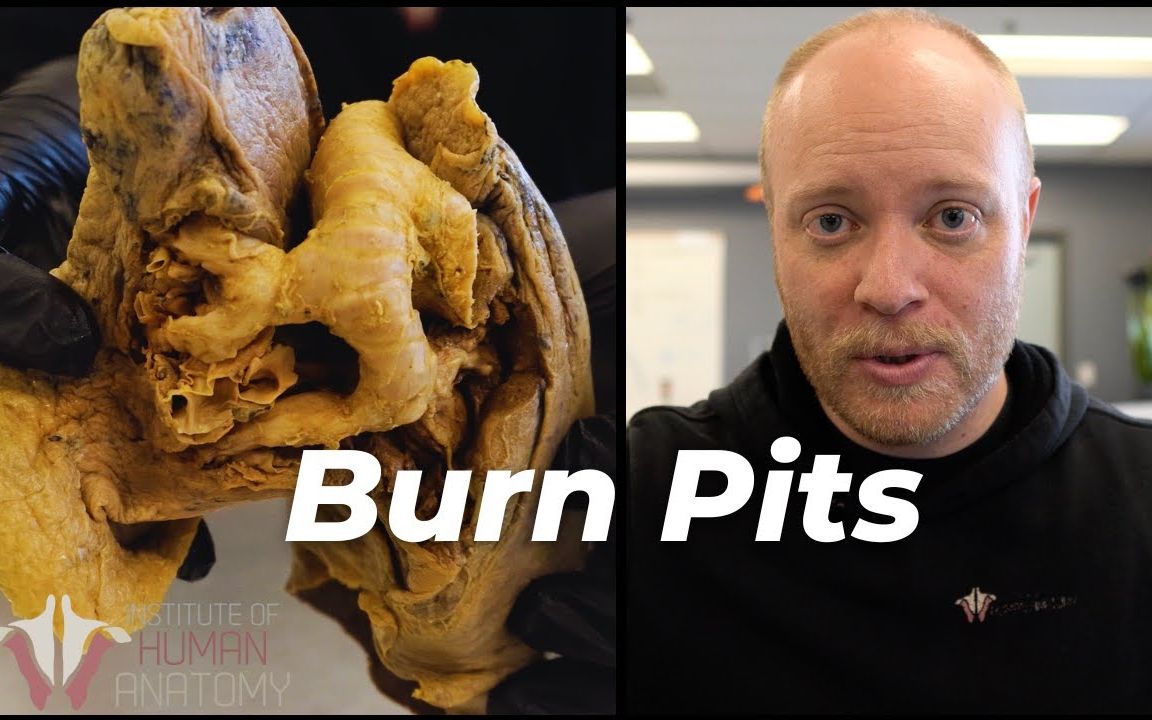 战争有多残酷 美烧坑退伍老兵后遗症 | 大体老师来了