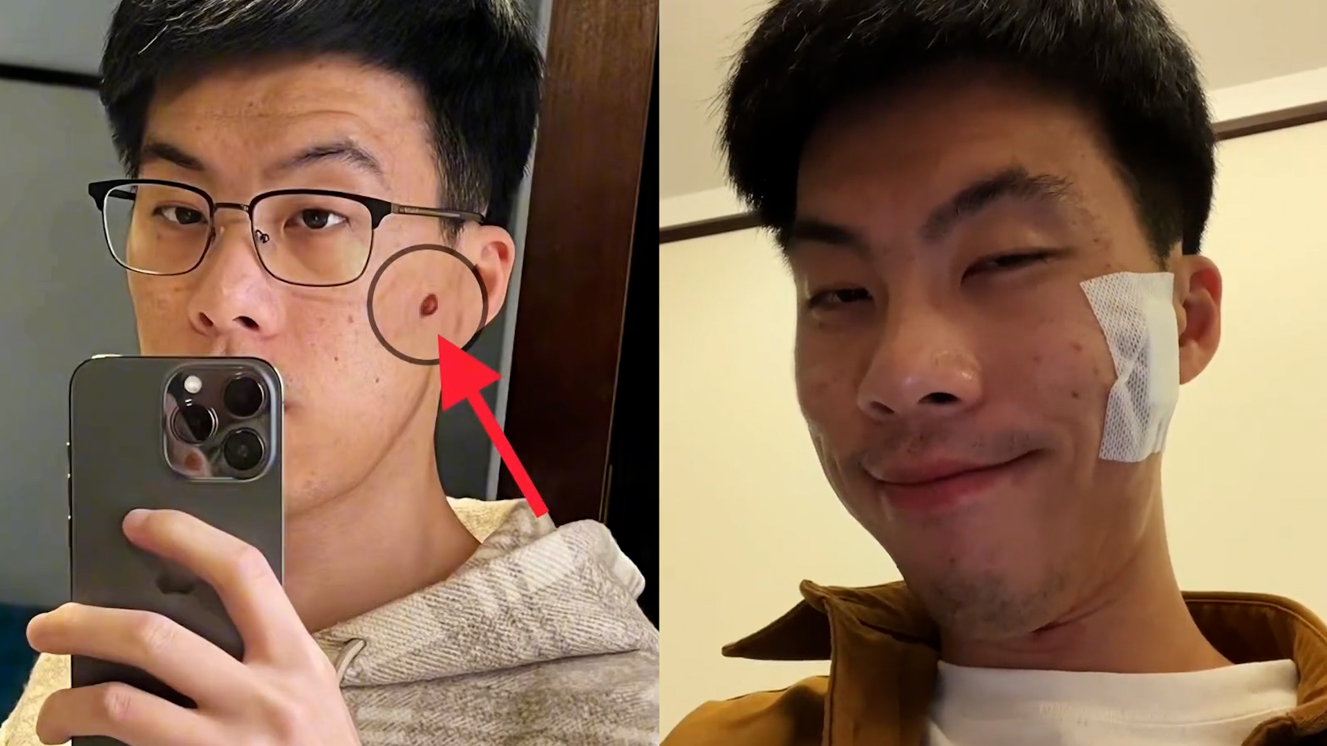 挤痘痘需谨慎!小伙挤痘痘血流不止,去医院检测发现痘痘变血管瘤