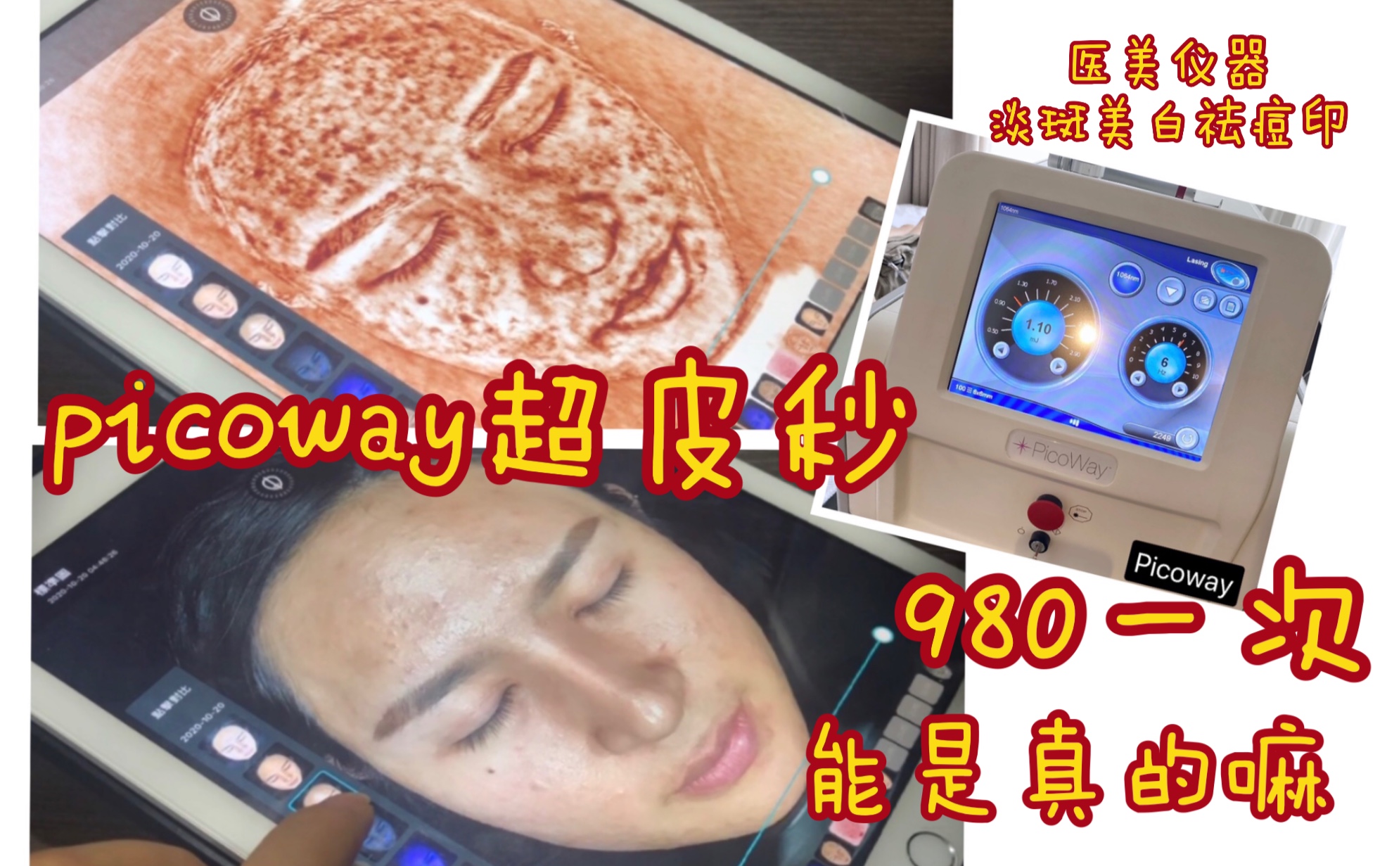 医美仪器小白首次尝试 范冰冰同款超皮秒 980一次 百分百是假货 美白...