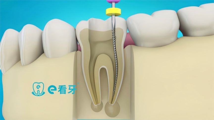 什么是根管治疗?