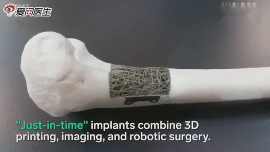 医学科普动画:个性化3D打印植入物,哪里缺少补哪里,科技真发达
