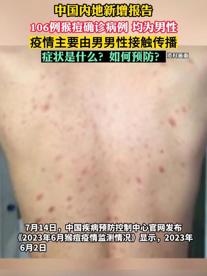 中国内地6月份新增106例猴痘确诊病例,疫情主要由男男性接触传播
...