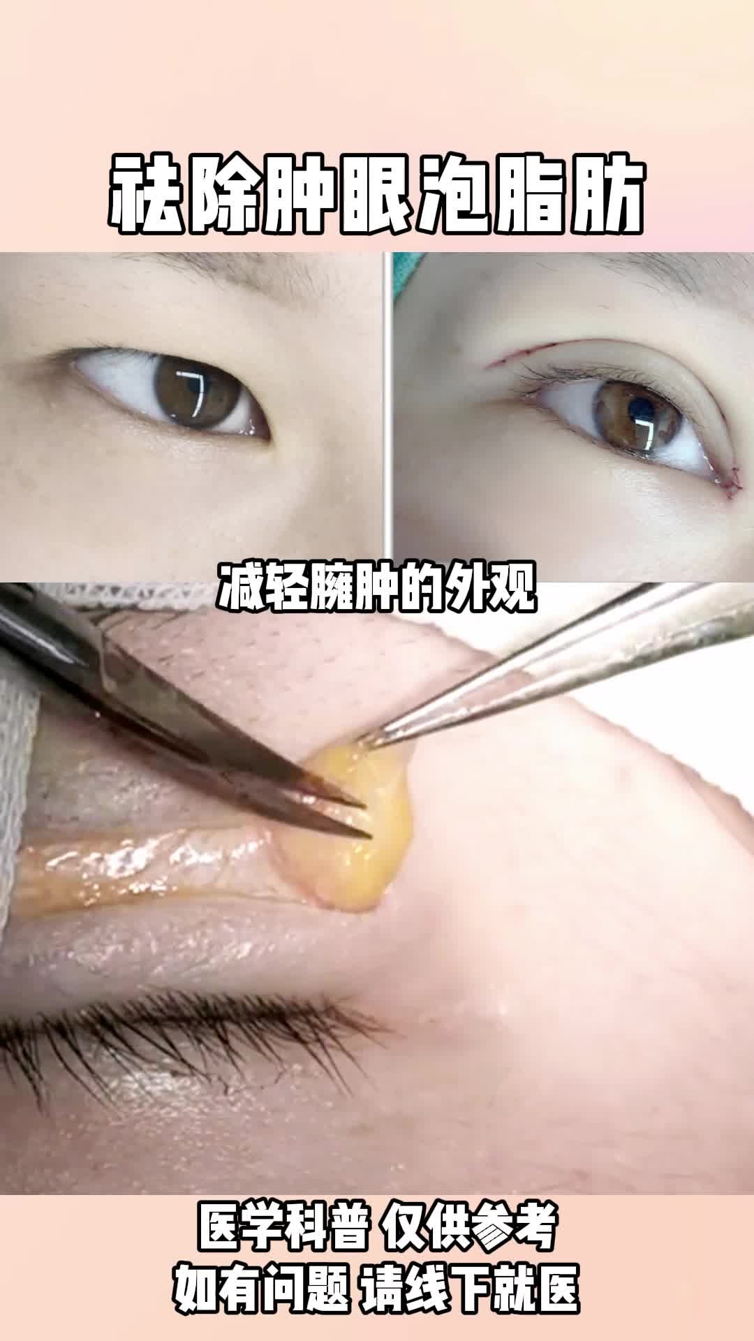肿眼泡里的脂肪太多了,强迫症想全都去掉!