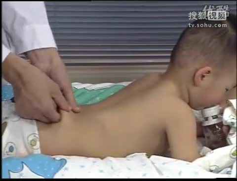 小儿推拿系列(9) 捏脊法