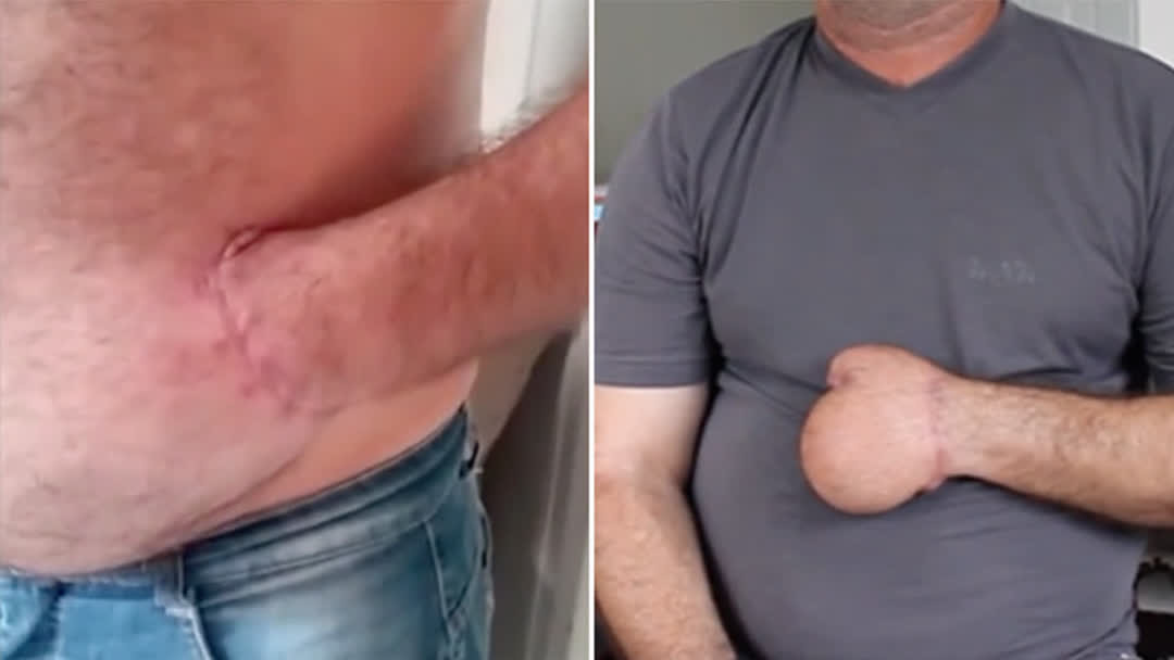 【世界异闻录】为避免截肢,他的手被缝进肚子