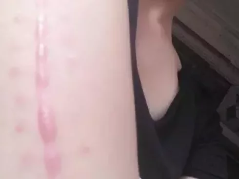 疤痕修复的方法有哪些?