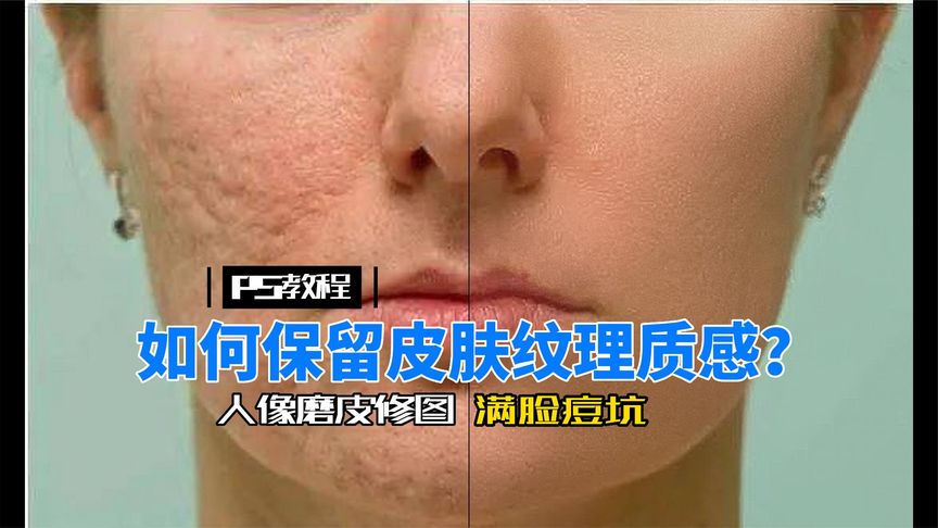 PS教程:人像磨皮修图,满脸痘坑如何磨皮和保留皮肤纹理质感
