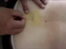 无痛皮下留置针疗法治疗局部痛点——下腰部痛点的局部疏拨治疗