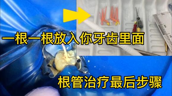 根管治疗最后一步,根管充填!