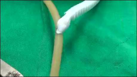 动静脉吻合技术4:血管吻合后的困难排除