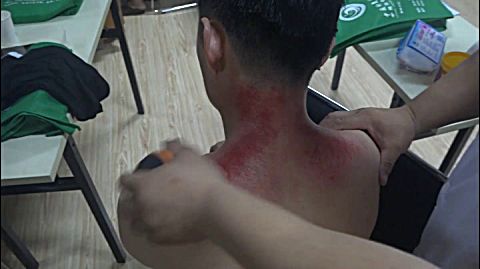 火龙罐颈肩部手法演示2