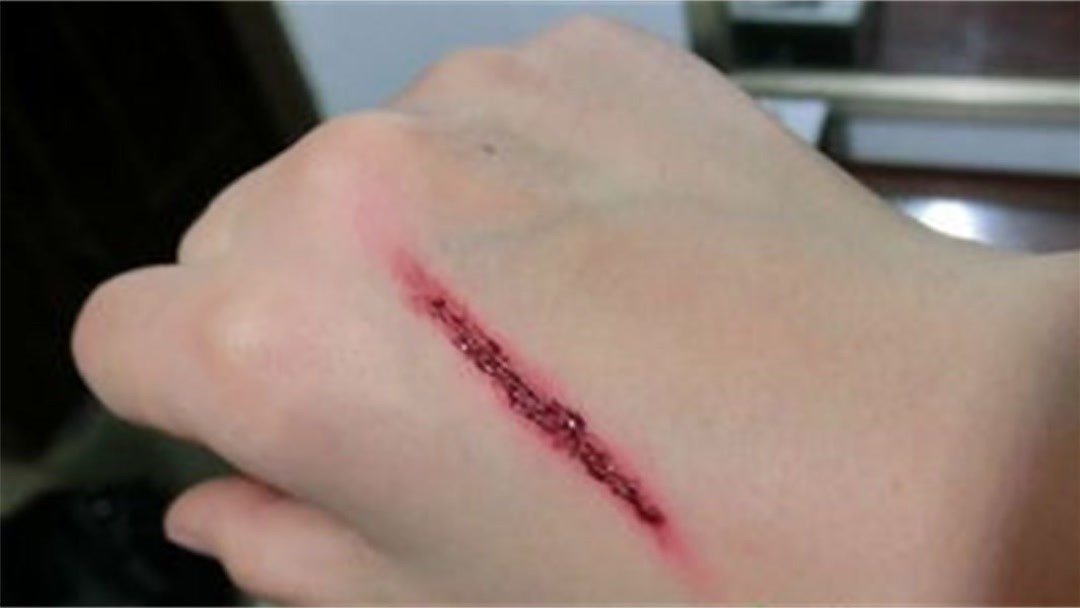 人受伤后伤口是怎样愈合的?当显微镜放大100倍后,场面一目了然