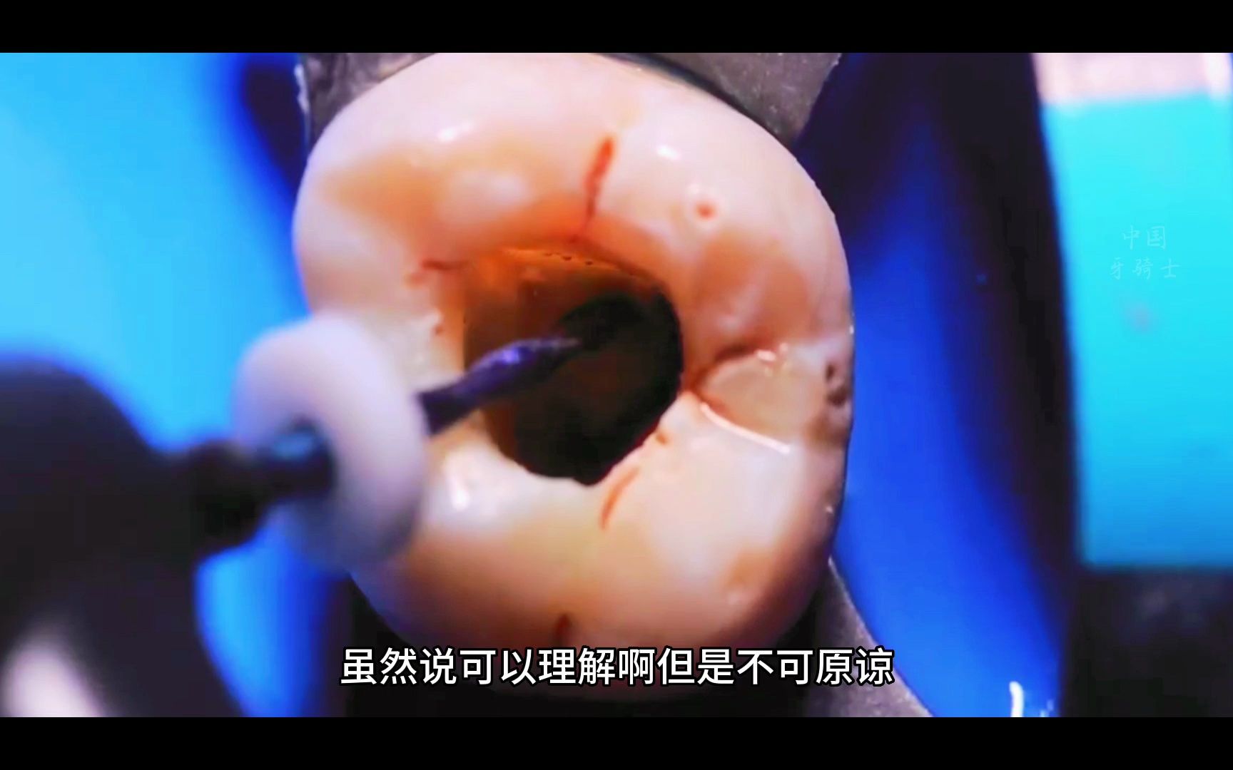 根管治疗第二步的全过程,既酸爽又解压~