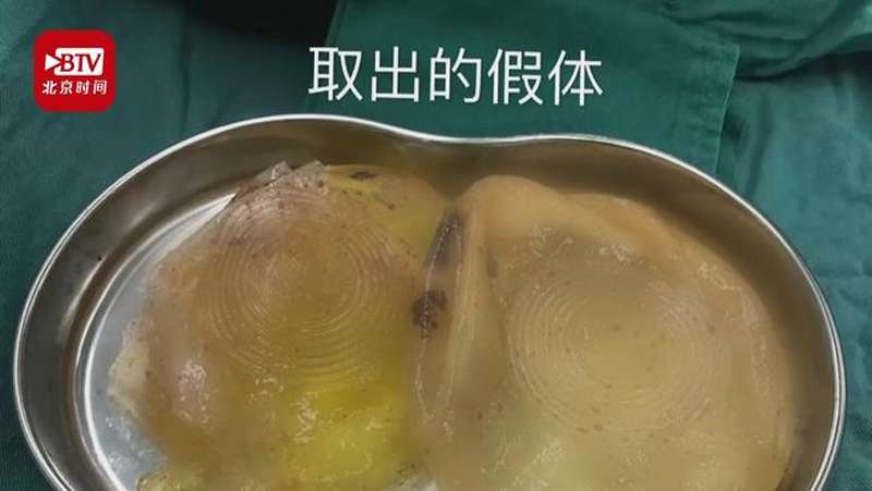 触目惊心!女子30年前隆胸假体破裂:多处组织坏死 液体喷涌而出