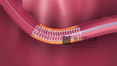A型栓塞三维动画