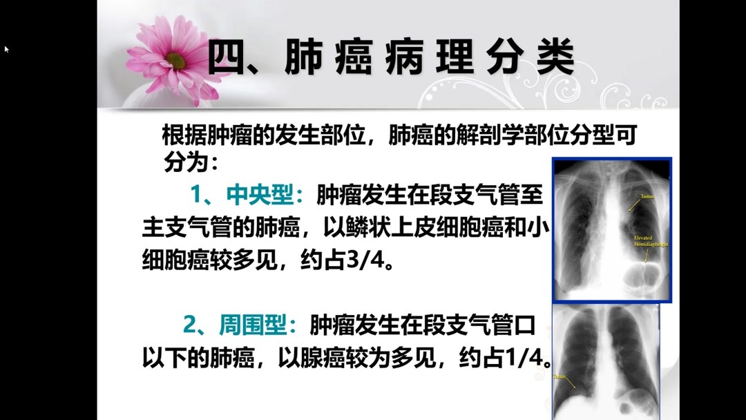 肺癌病人的护理PPT