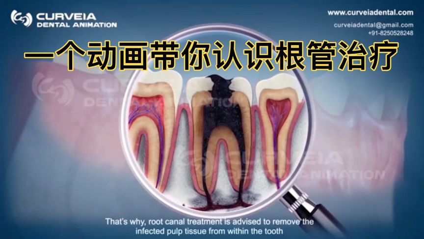 一个动画带你认识根管治疗