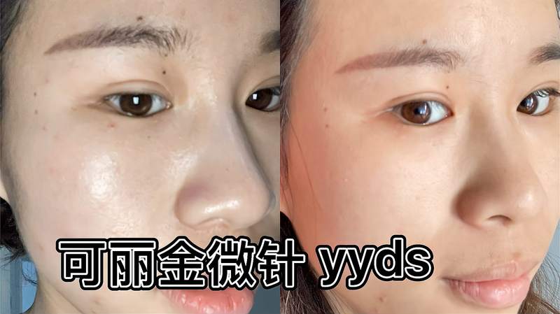 微针:让皮肤发光的秘密