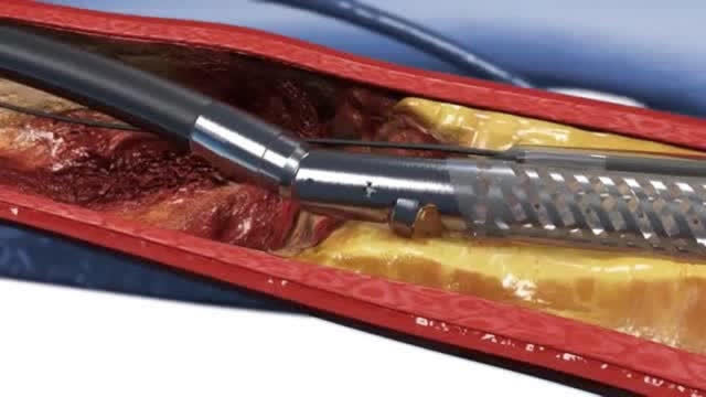 动画科普,介入血栓清除