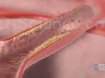 临床医学3D动画 演示