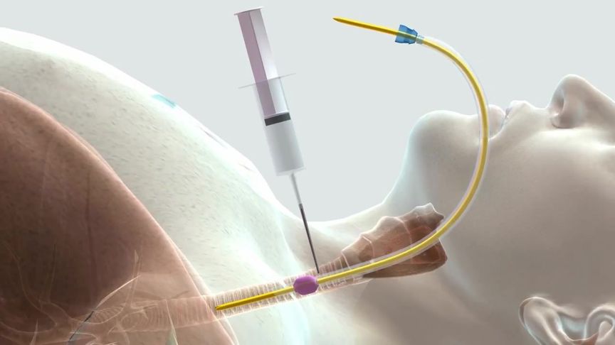 气管切开,是这么切的!ICU医生操作、麻醉科医生操作。