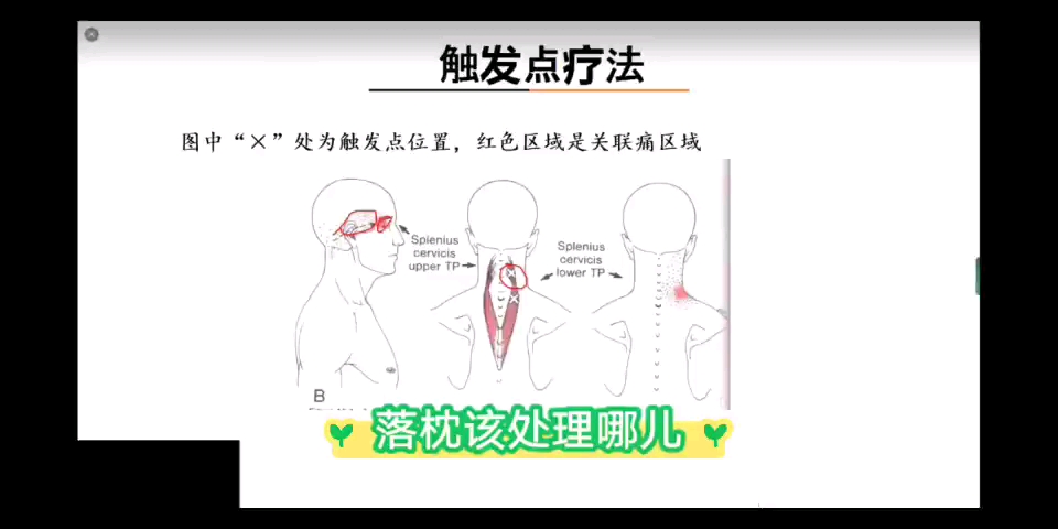 落枕该处理哪儿