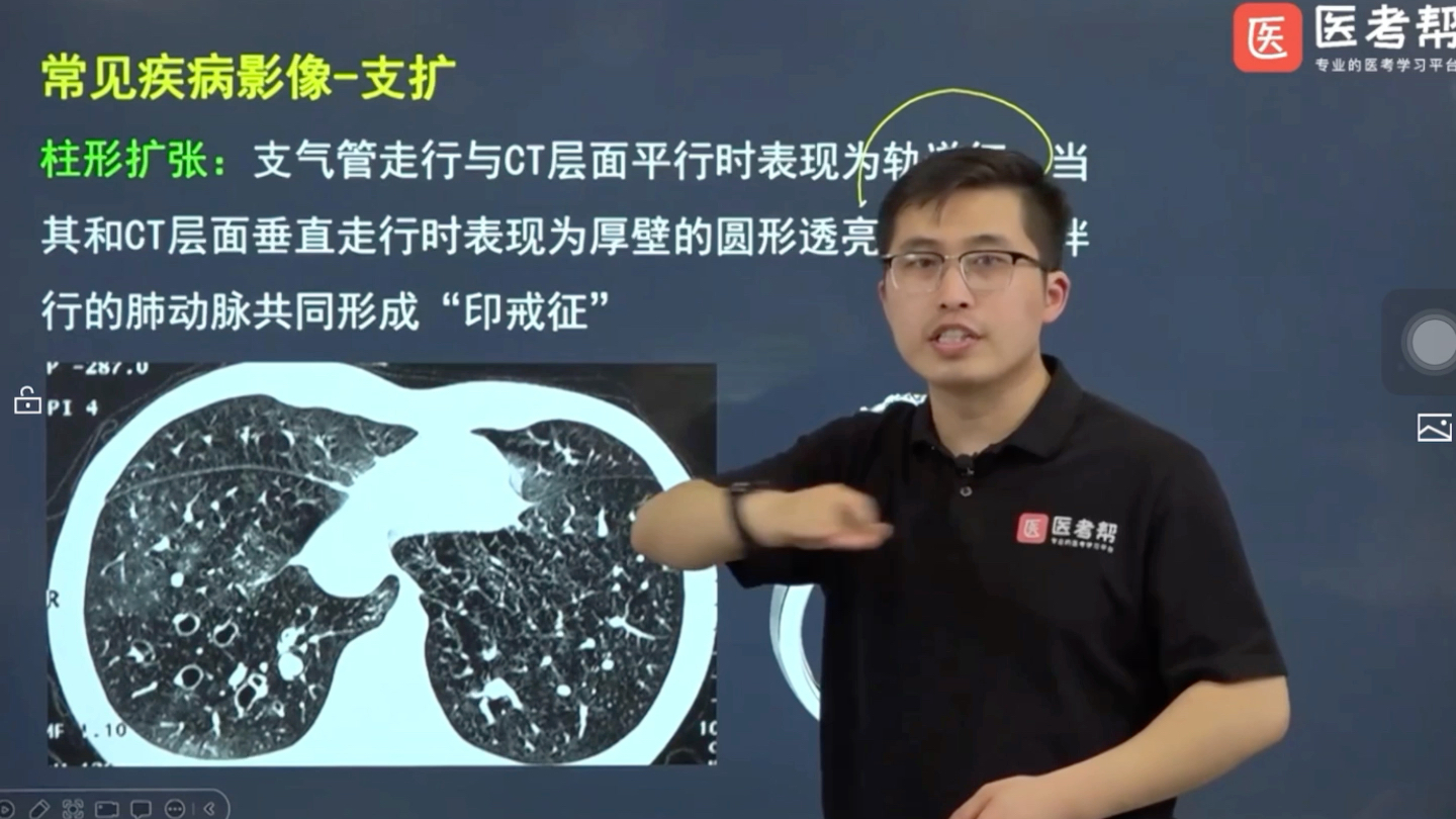 肺部CT之支气管扩张