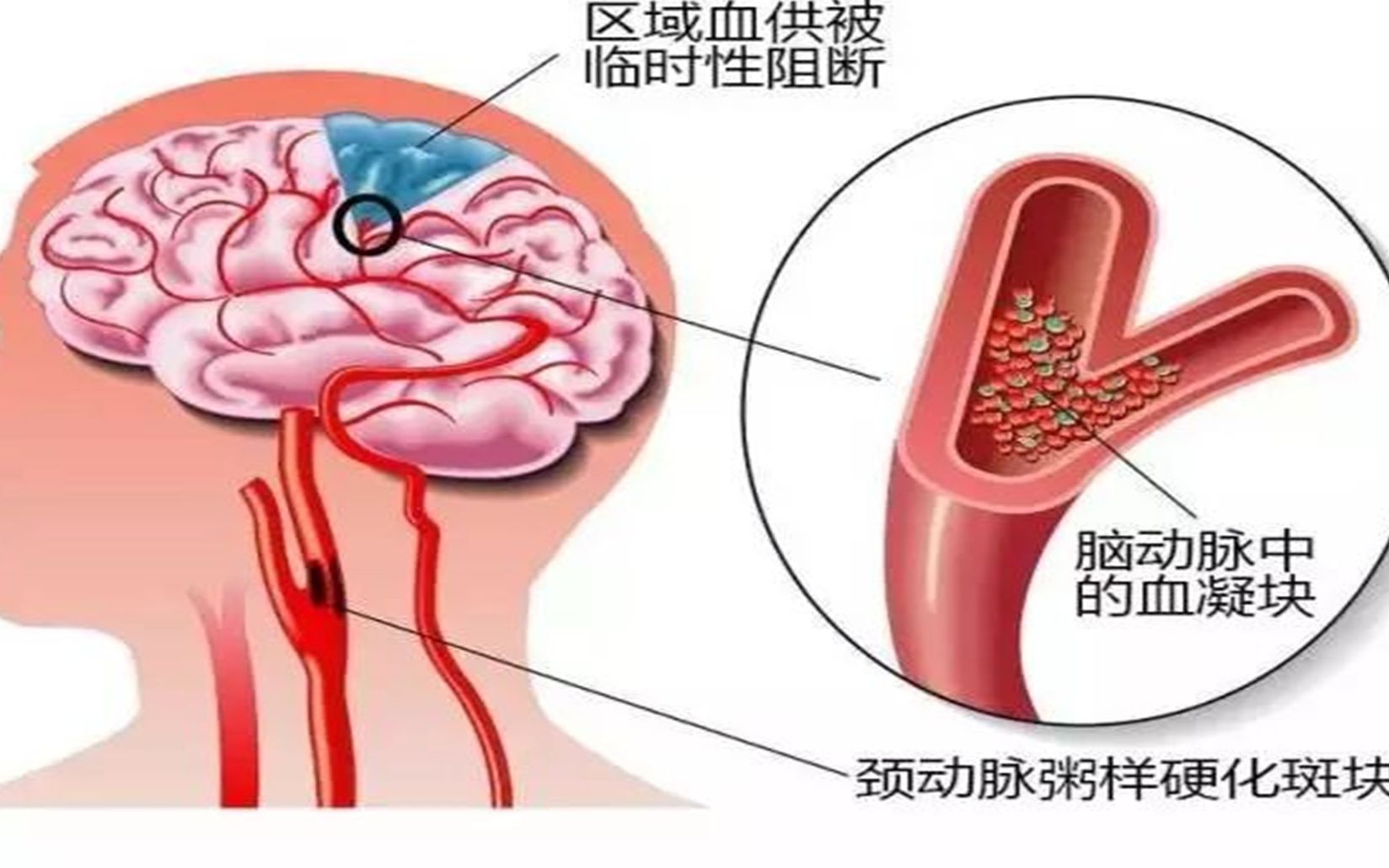 适合于血管斑块、颈动脉斑块、冠心病的良方——调肝通脉汤是首选