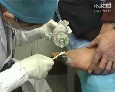 非手术治疗血栓闭塞性脉管炎动脉硬化性闭塞症雷诺氏症静脉血栓多