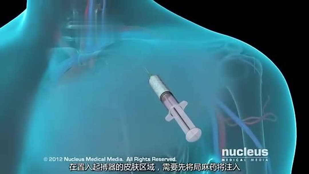 3D演示心脏起搏器植入过程