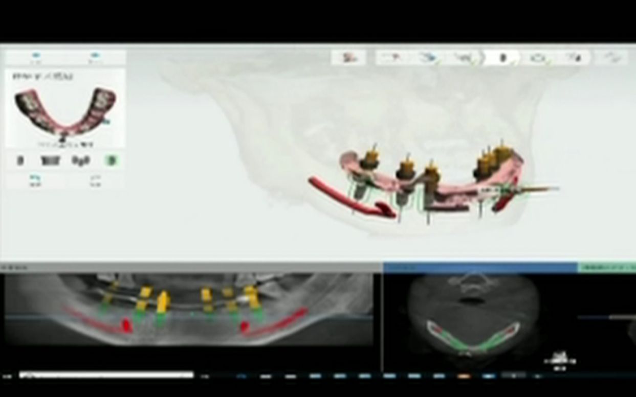 第五期《“齿”处有讲究》于国跃访谈:无痛微创的数字化模拟种植牙