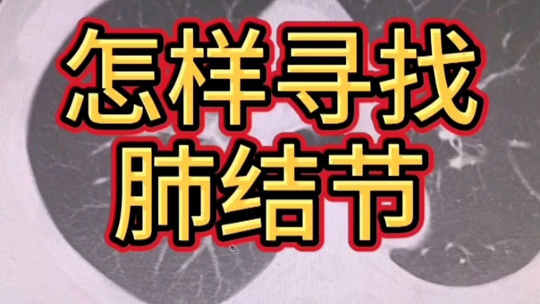 放射科医生教你怎样在胸部CT上寻找肺结节?