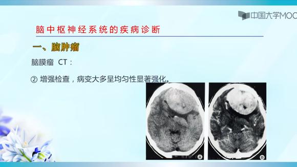 【医学影像学】中枢神经系统常见疾病诊断1