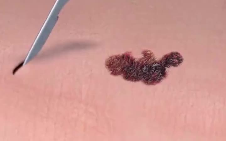 ...脸上都会长一些痣,有的好看,有的却不雅观,那么这些事怎么去掉的呢?