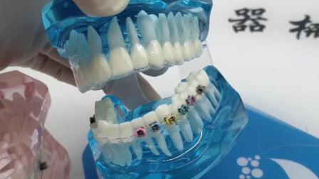 隐形正畸模型