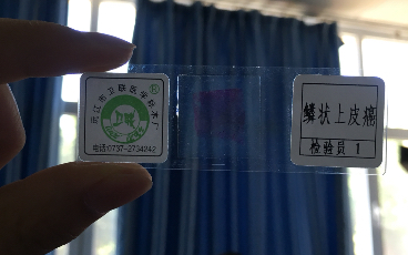 鳞状上皮癌病理组织切片(1)