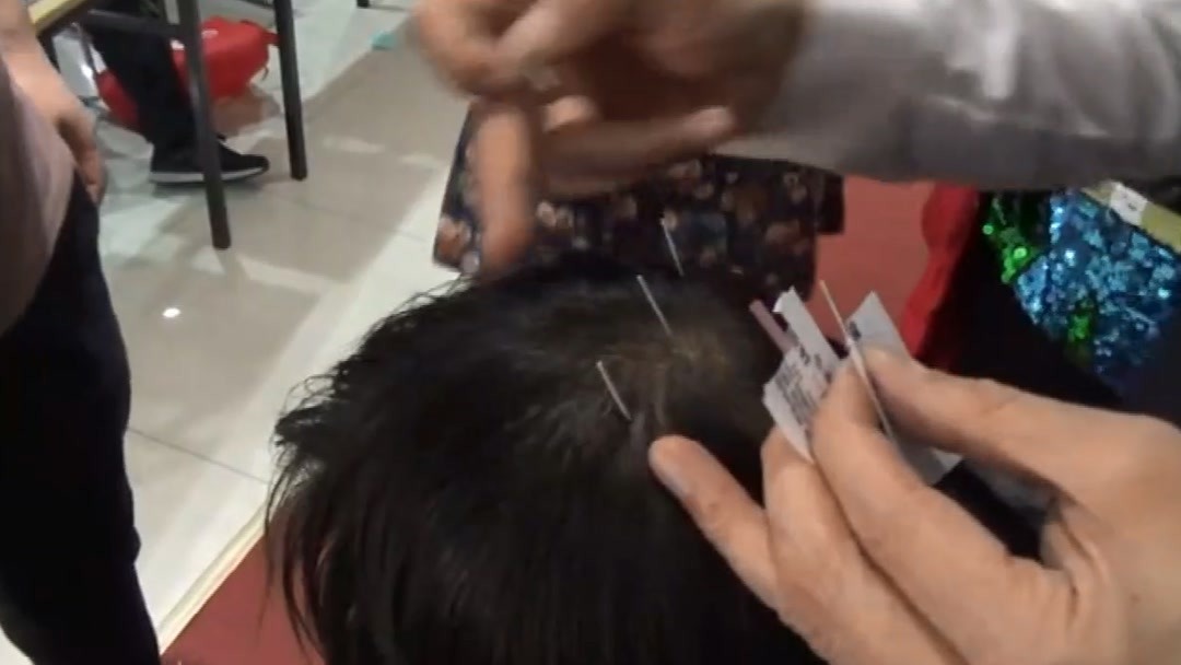 吴士杰吴氏无痛一针法-怪三针强心二针左鼻翼