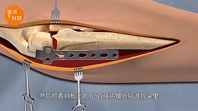 骨折有多疼?3D动画模拟治疗全过程,网友:隔着屏幕瑟瑟发抖