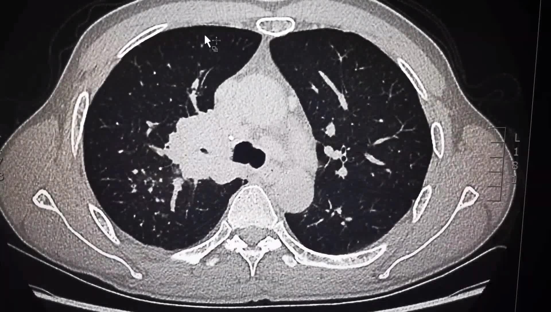 中央型肺癌CT表现,直接征象及间接征象!